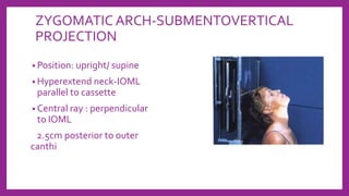Submentovertical Zygomatic Arches