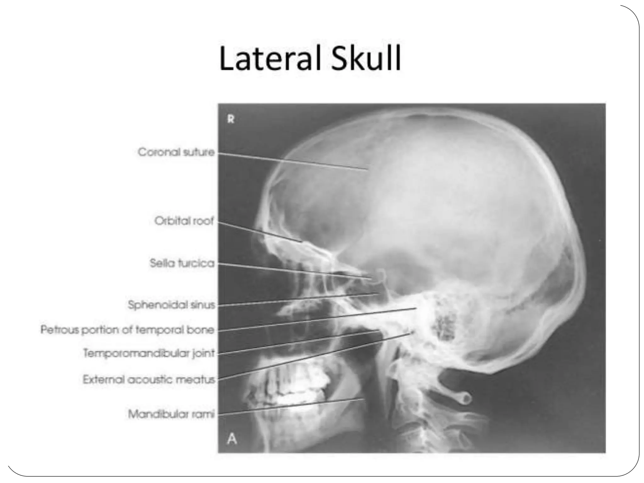Skull anatomy and positioning | PPTX