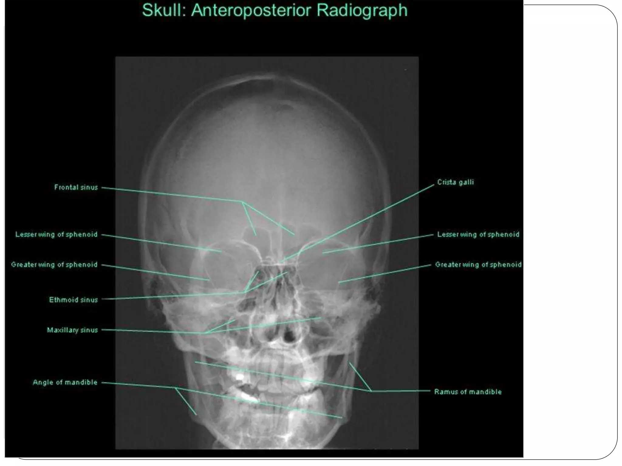 Skull anatomy and positioning | PPTX