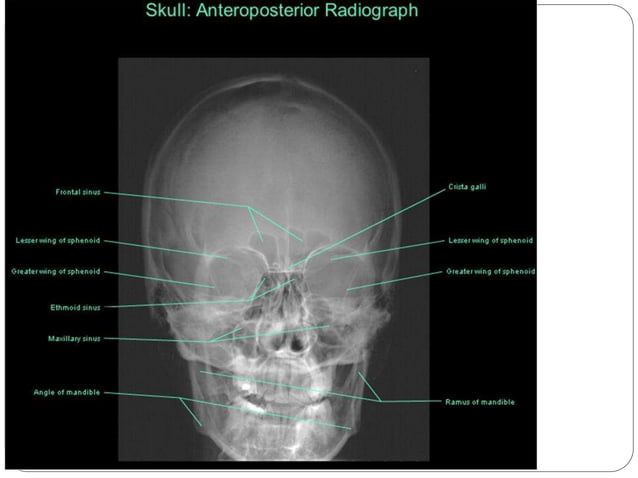 Skull anatomy and positioning | PPTX