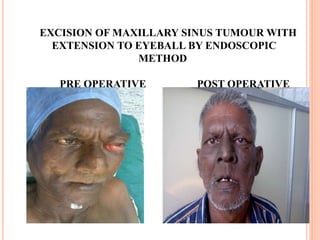 Endoscopic SKULL BASE surgery | PPTX