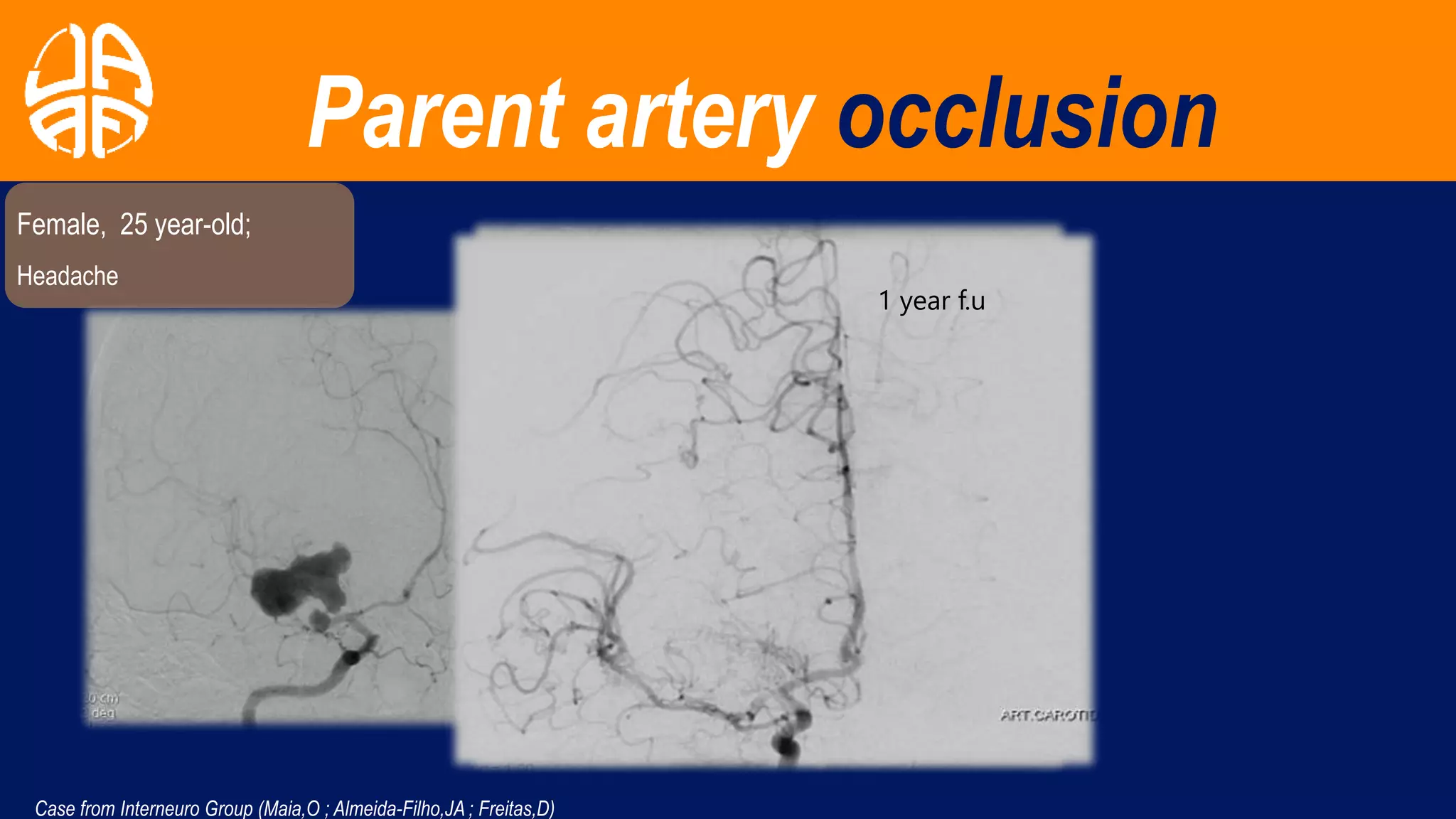Skull Base.Endovascular approach for giant aneurism of anterior ...