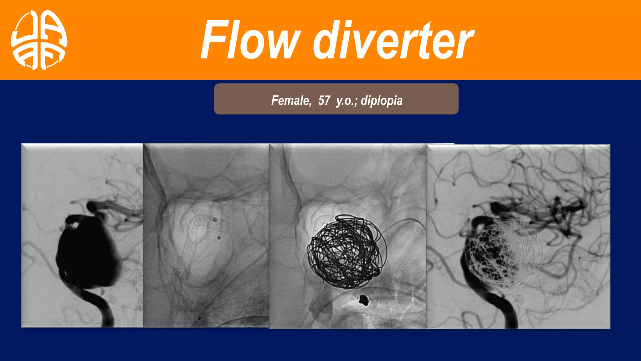 Skull Base.Endovascular approach for giant aneurism of anterior ...