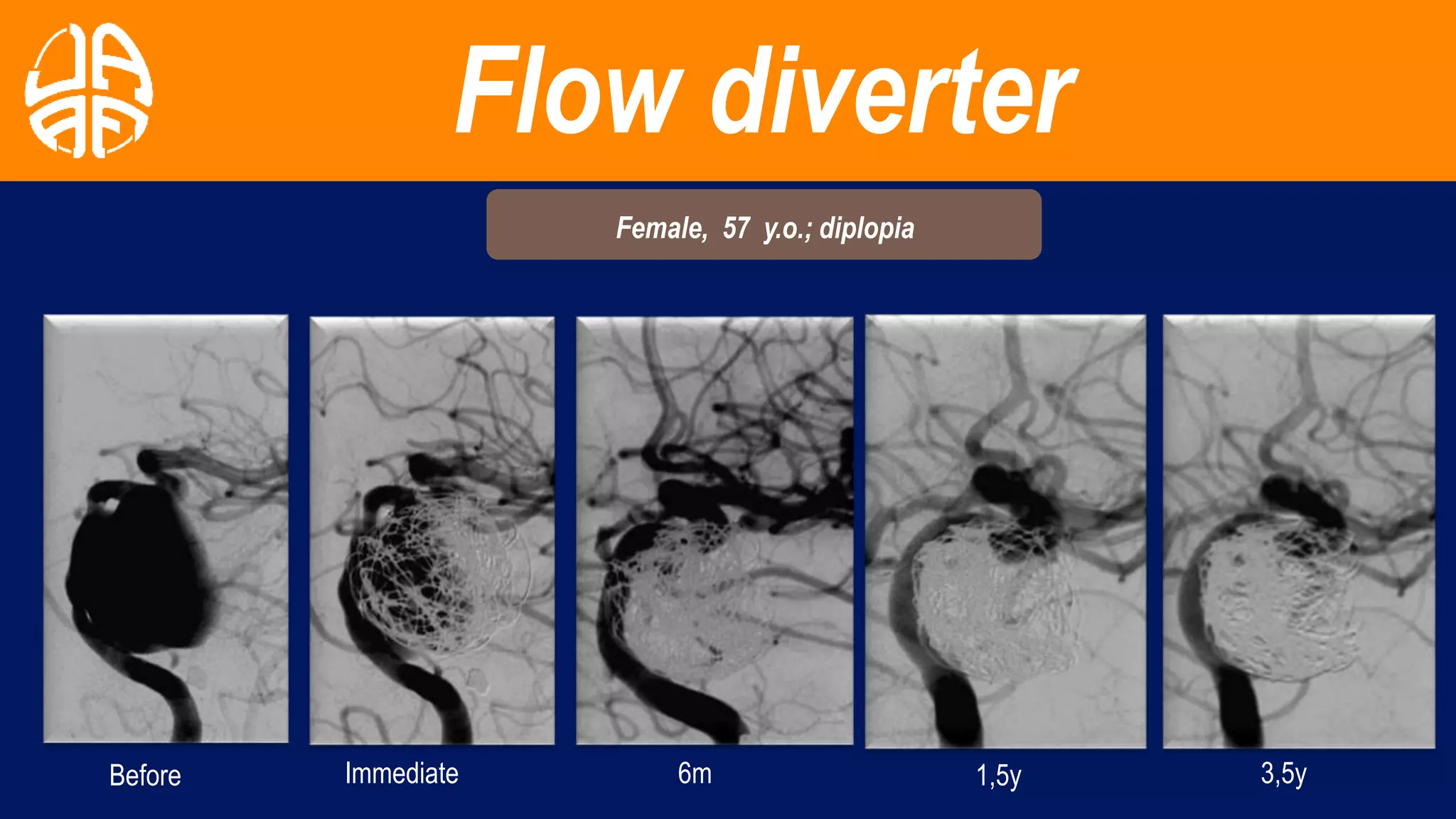 Skull Base.Endovascular approach for giant aneurism of anterior ...