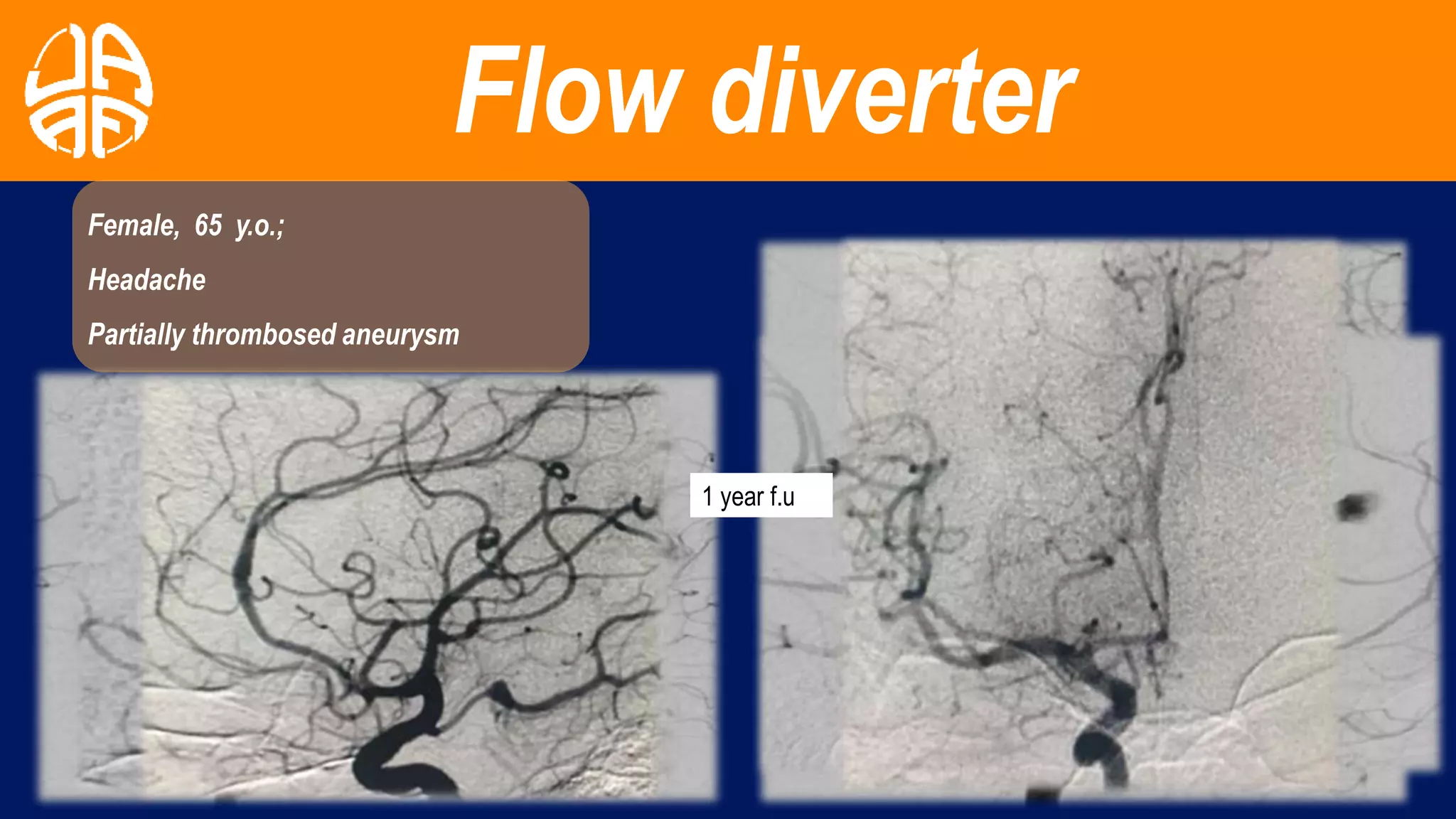 Skull Base.Endovascular approach for giant aneurism of anterior ...