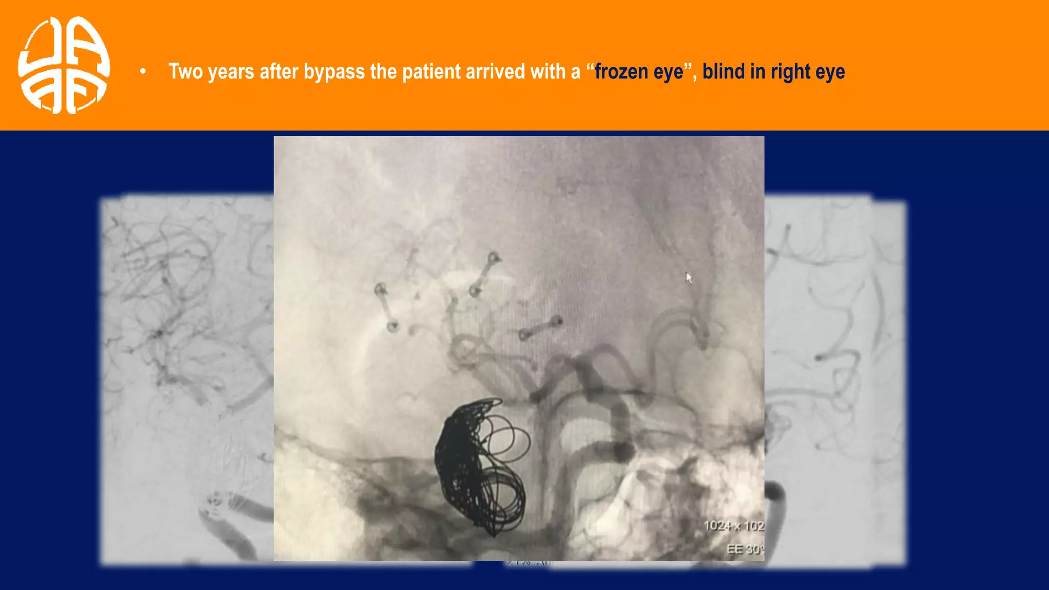 Skull Base.Endovascular approach for giant aneurism of anterior ...