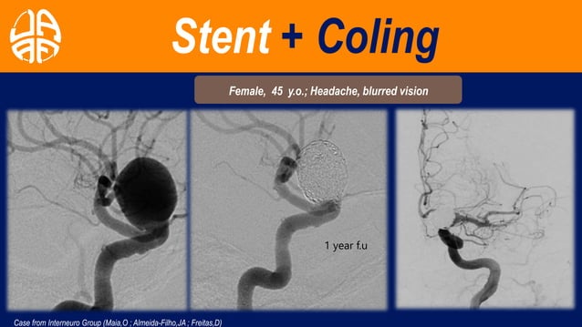 Skull Base.Endovascular approach for giant aneurism of anterior ...