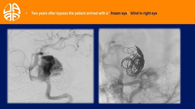 Skull Base.Endovascular approach for giant aneurism of anterior ...