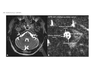 Diagnostic imaging approach in skull base lesions | PPTX