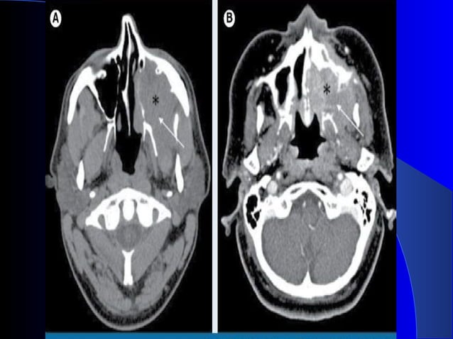 SKULL BASE IMAGING | PPT | Bone and Joint Conditions | Diseases and ...