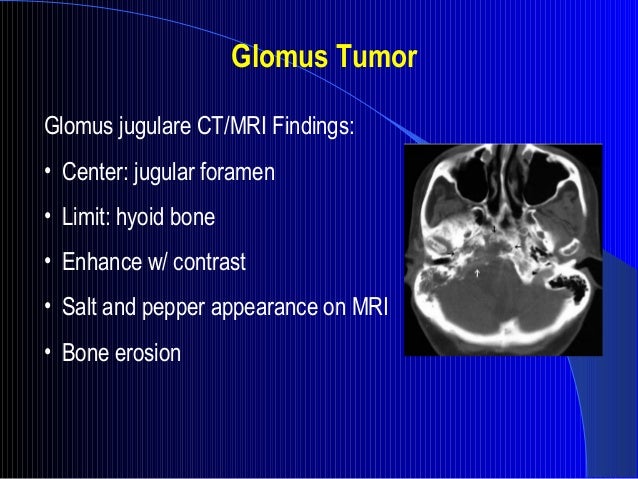 Glomus Tumor Ear