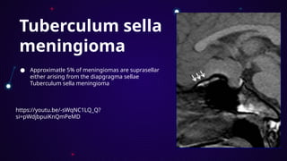 Skull based meningioma .pptx, for neurosurgery | PPTX