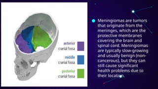 Skull based meningioma .pptx, for neurosurgery | PPTX