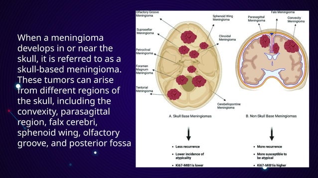 Skull based meningioma .pptx, for neurosurgery | PPTX