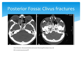 Skull Base fractures ( PDFDrive ).pdf