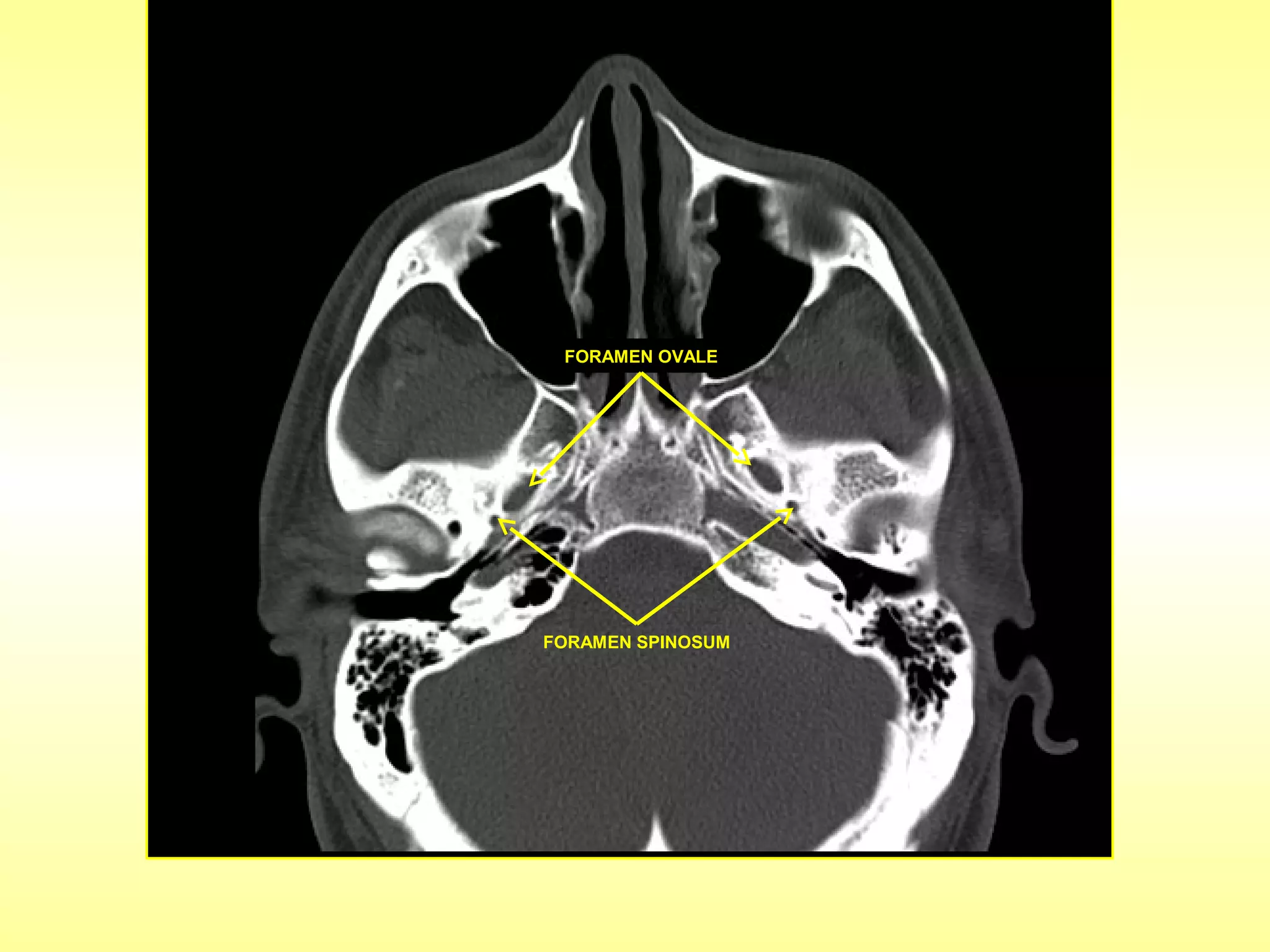 Skull base imaging | PPT