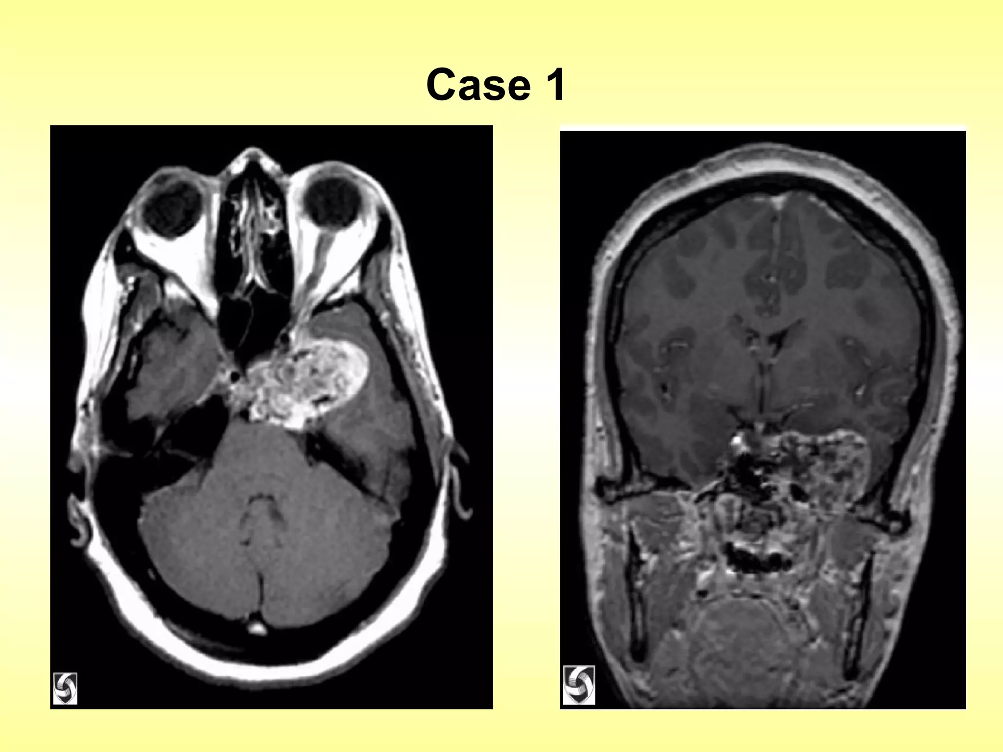 Skull base imaging | PPT