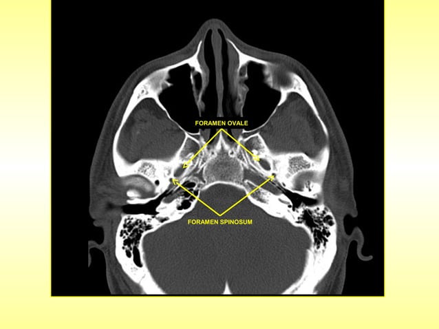 Skull base imaging | PPT | Ear, Nose and Throat Conditions | Diseases ...