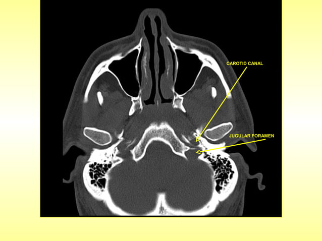 Skull base imaging | PPT | Ear, Nose and Throat Conditions | Diseases ...