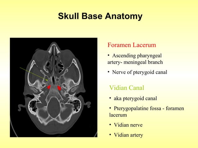 Skull base imaging | PPT | Ear, Nose and Throat Conditions | Diseases ...