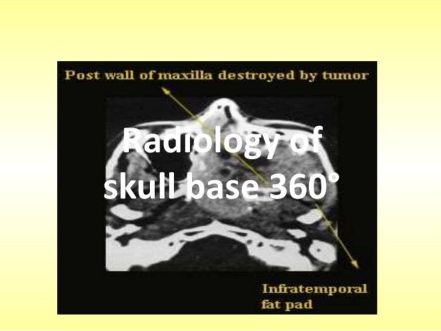 Skull base imaging | PPT | Ear, Nose and Throat Conditions | Diseases ...