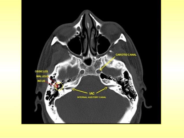 Internal auditory canal mri anatomy - havenfiln