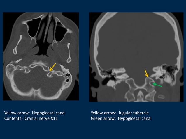skullbase imaging.pptx | Ear, Nose and Throat Conditions | Diseases and ...