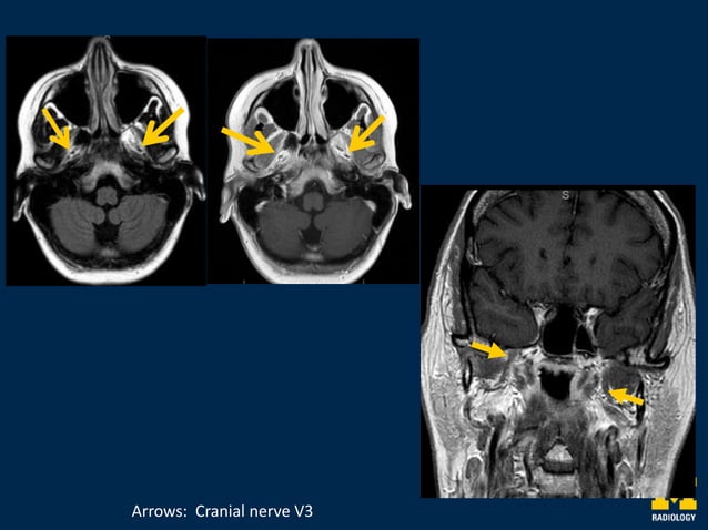 skullbase imaging.pptx | Ear, Nose and Throat Conditions | Diseases and ...