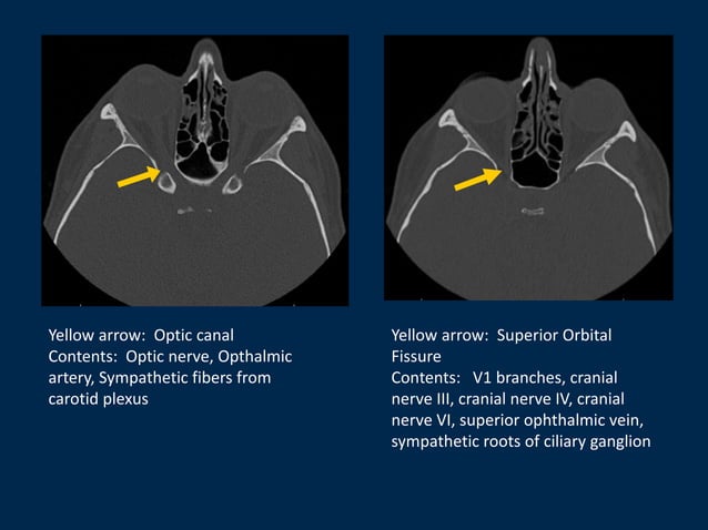 skullbase imaging.pptx | Ear, Nose and Throat Conditions | Diseases and ...