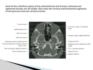 SKULL BASE OVERVIEW anatomy anteroir middle and posterior | PPT