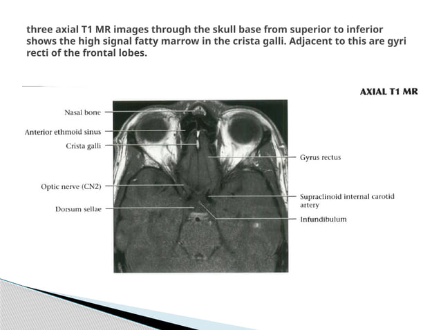 SKULL BASE OVERVIEW anatomy anteroir middle and posterior | PPT