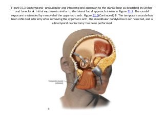 Skull base recontruction 360° | PPTX