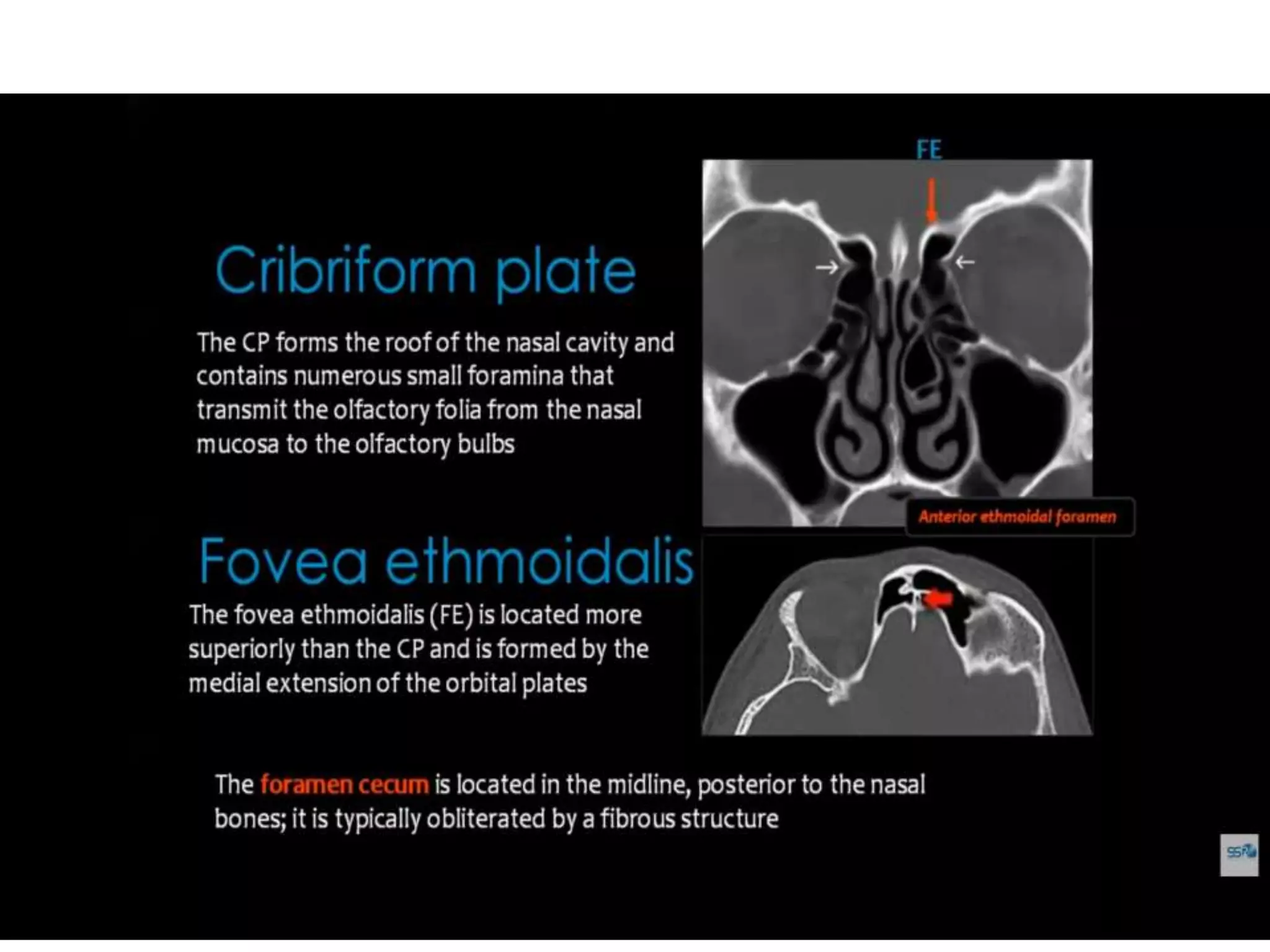 skull base vish.pptx