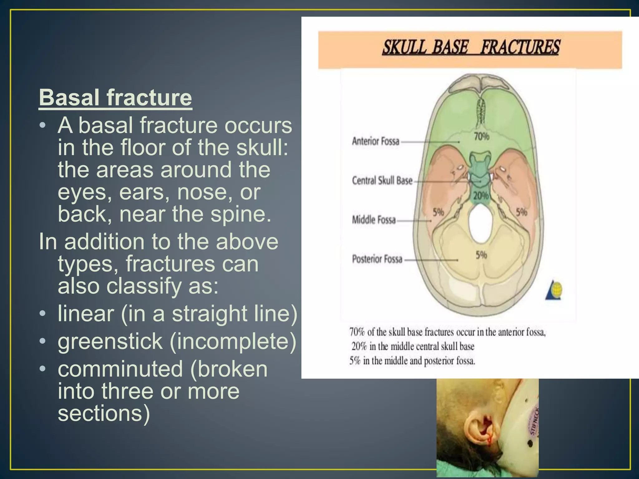 Skull fractures | PPTX