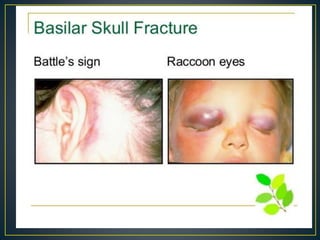 Basilar Skull Fracture