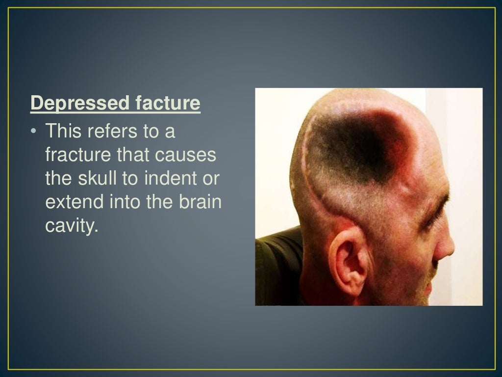 Skull Fractures