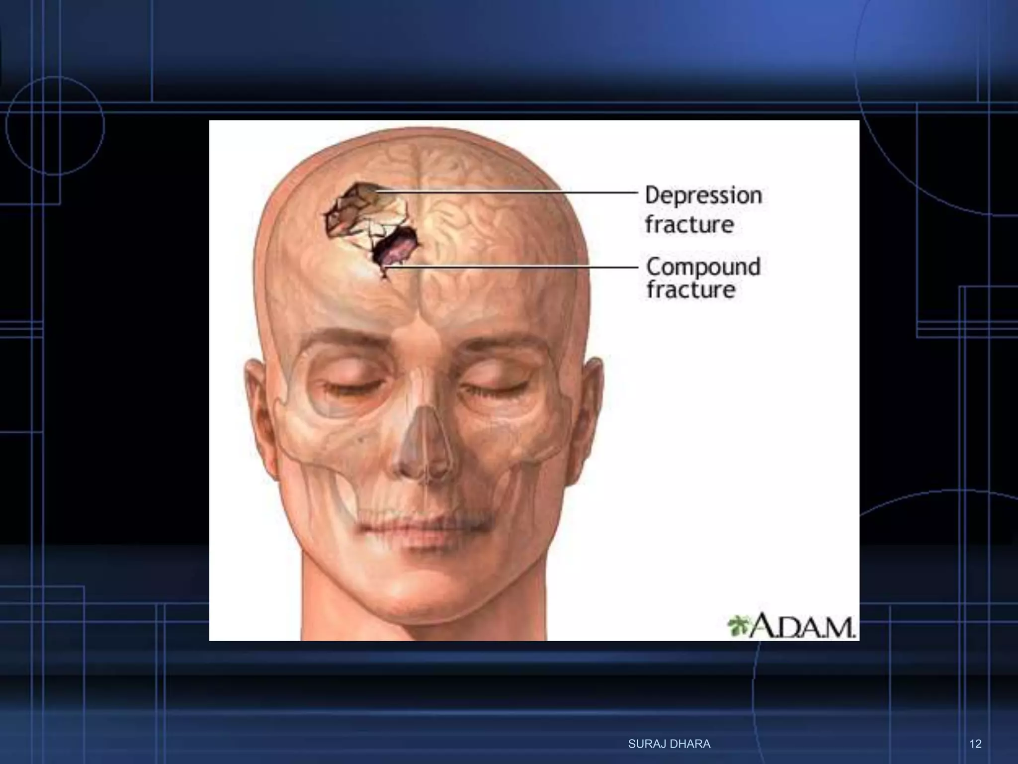 Skull fractures (Regional injury part - 1) | PPTX