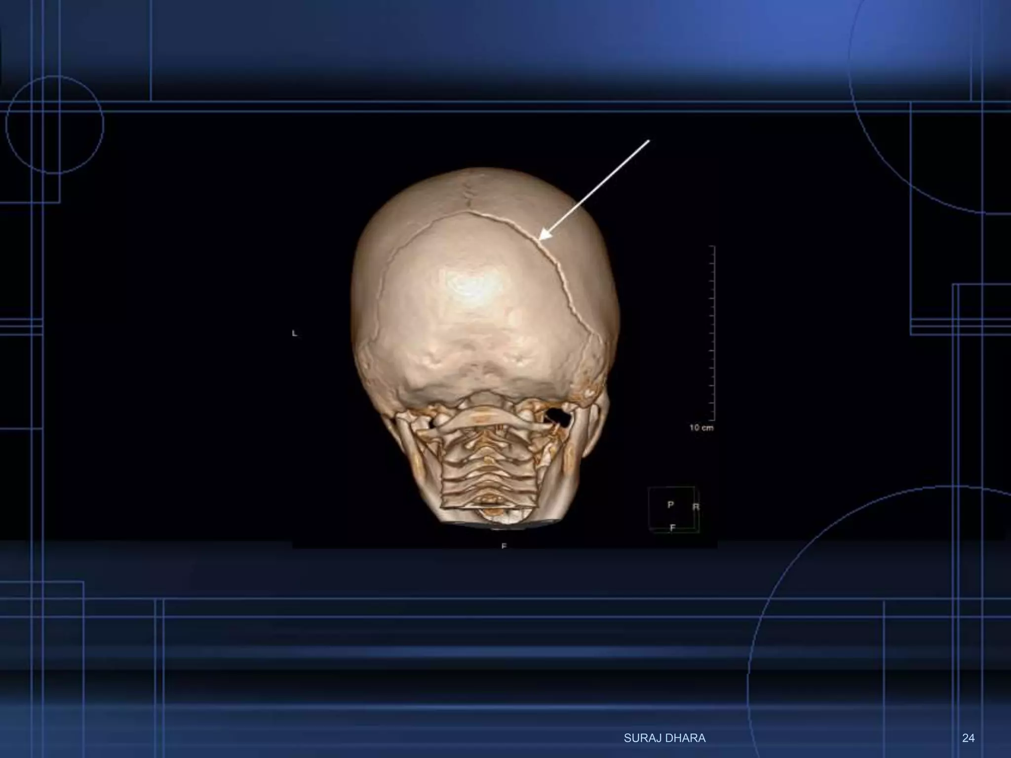 Skull fractures (Regional injury part - 1) | PPTX
