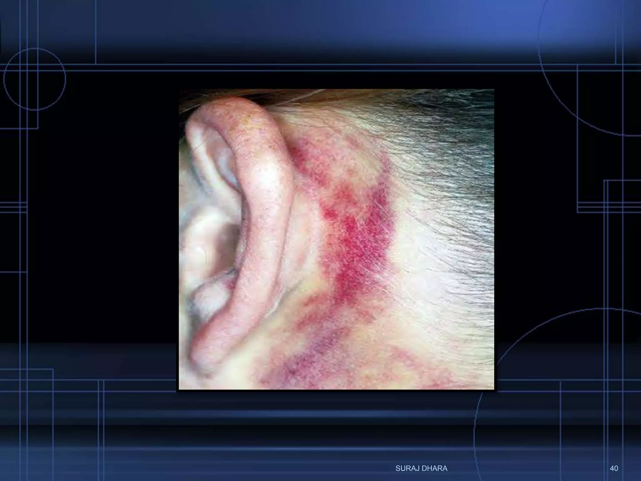 Skull fractures (Regional injury part - 1) | PPTX | First Aid | Injuries