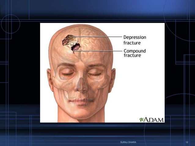 Skull fractures (Regional injury part - 1) | PPTX | First Aid | Injuries