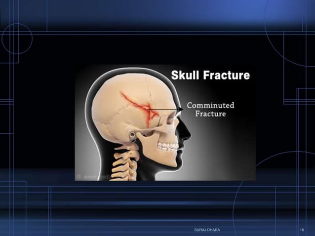 Skull fractures (Regional injury part - 1) | PPTX | First Aid | Injuries