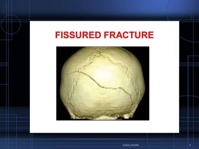 Skull fractures (Regional injury part - 1) | PPTX | First Aid | Injuries