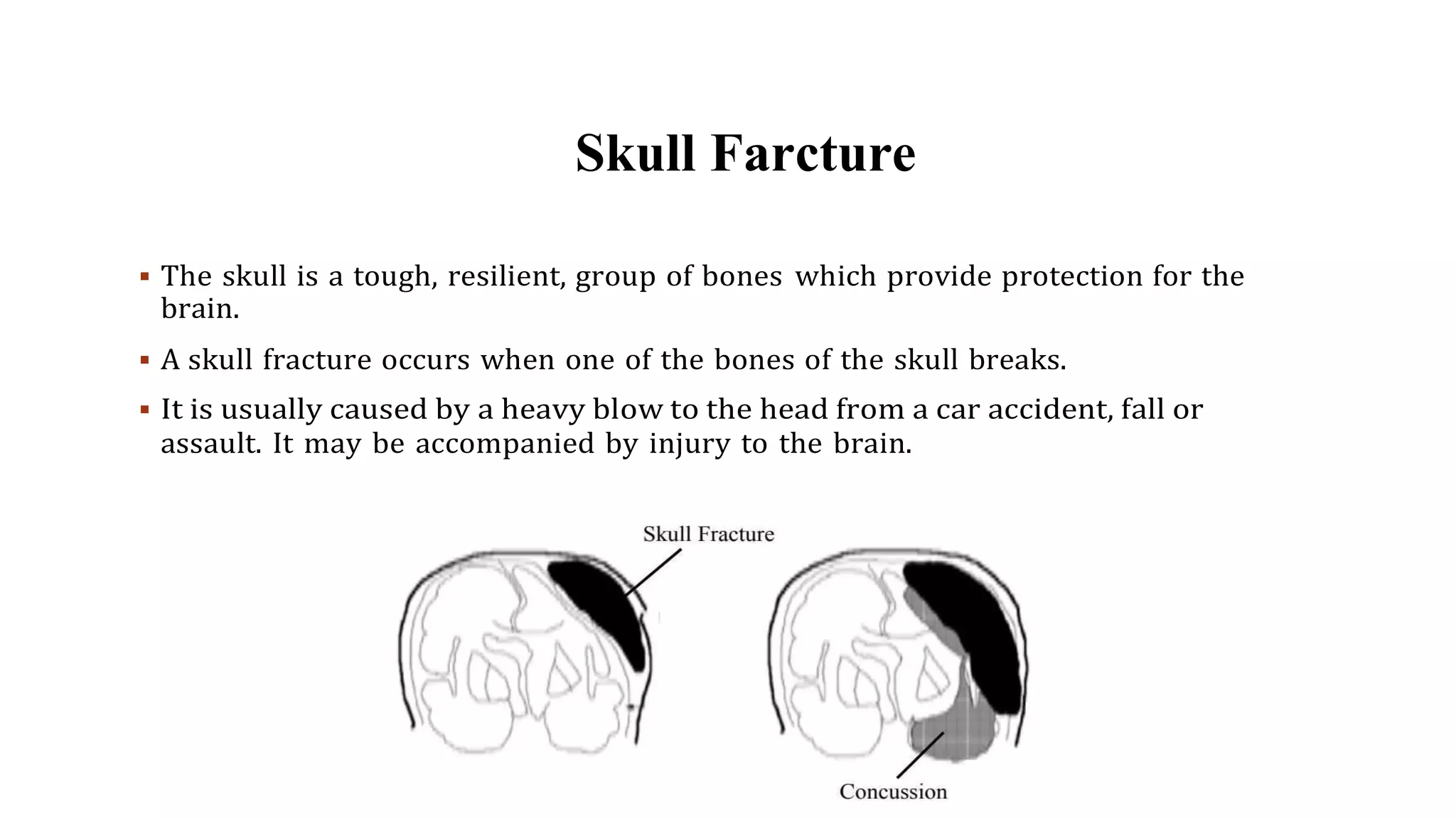 skull fractures.pdf