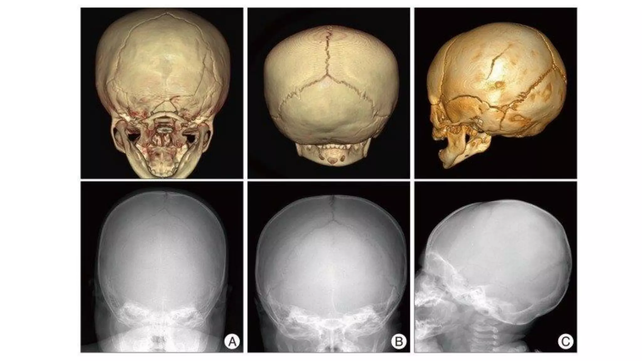 skull fractures.pdf | Death, Injury, or Military Conflict | Sensitive Topics