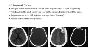 skull fractures.pdf | Death, Injury, or Military Conflict | Sensitive ...