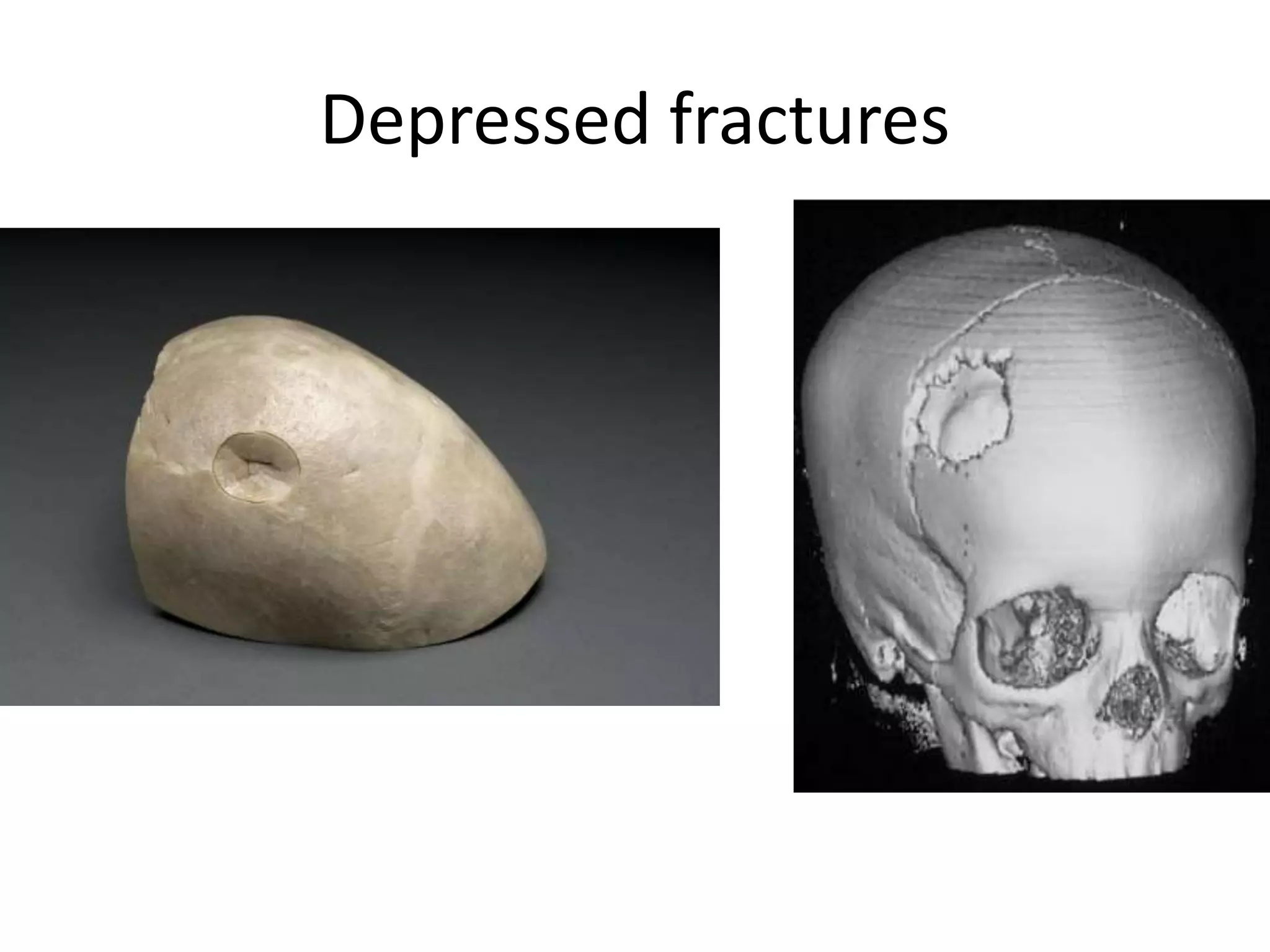 Skull fractures- forensic aspects MBsingh,S.Dhara,DrY.Hameed | PPTX