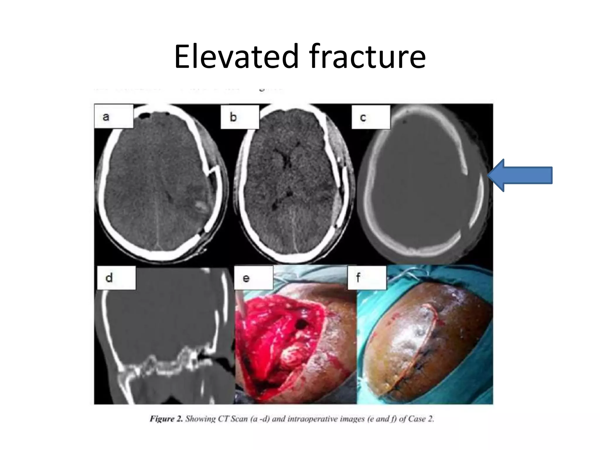 Skull fractures- forensic aspects MBsingh,S.Dhara,DrY.Hameed | PPTX