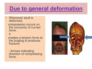 Compression Fracture Skull