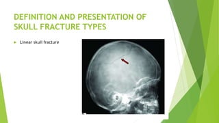 Skull fractures in adults | PPTX