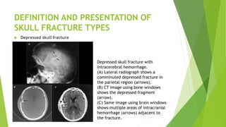 Skull fractures in adults | PPTX